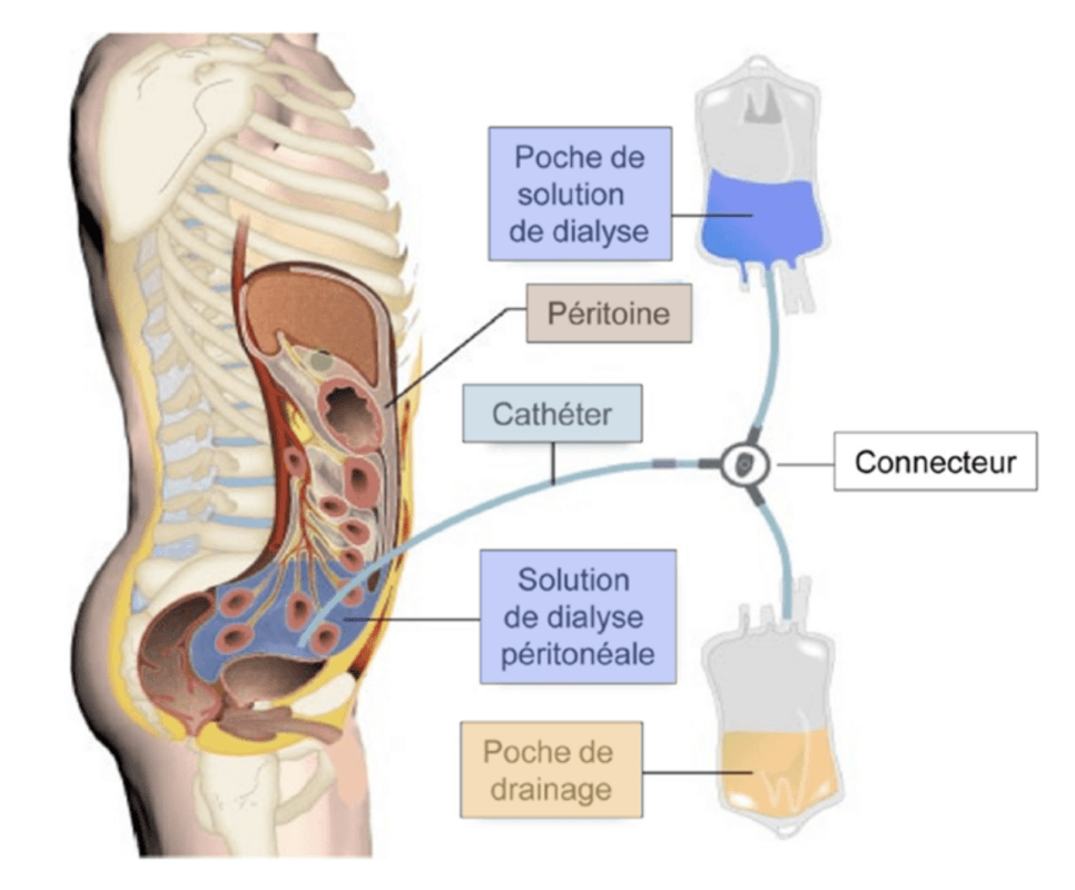 Dialyse et insuffisance rénale : Définition et traitement - Nutrisens